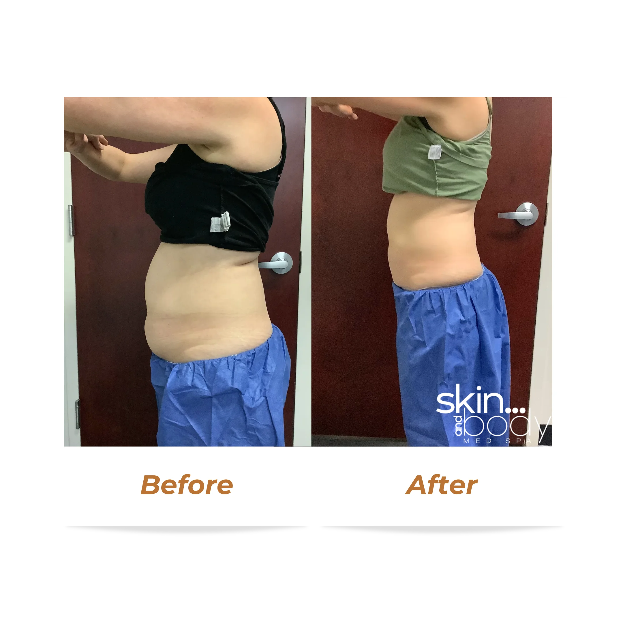Before and After Gallery Photos | Skin and Body Med Spa